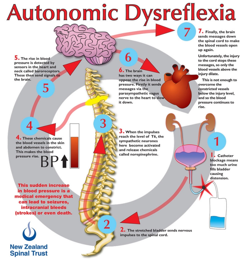 What is Autonomic Dysreflexia? - Total Community Care